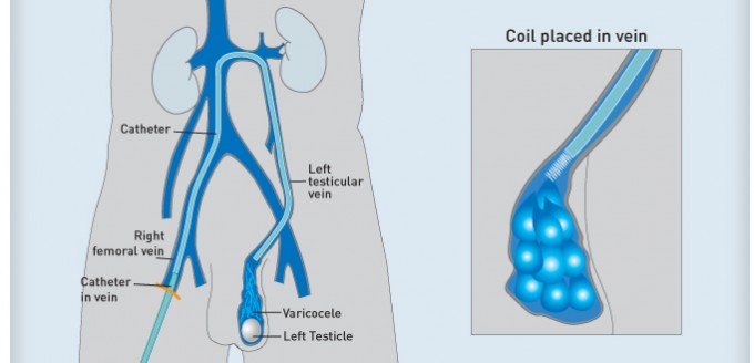 Varicocele - JDS Homoeopathic Hospital