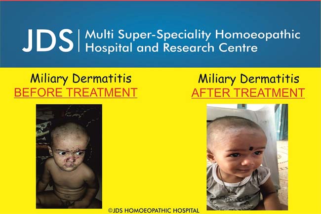Miliary Rash-final – JDS Homoeopathic Hospital